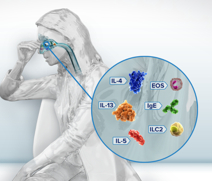 Type 2 Inflammation in CRSwNP